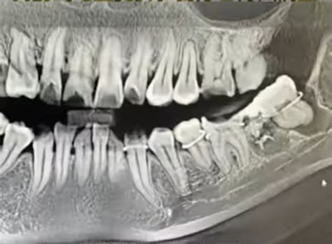 Woman In China Has Wrong Tooth Extracted And Reinserted Without