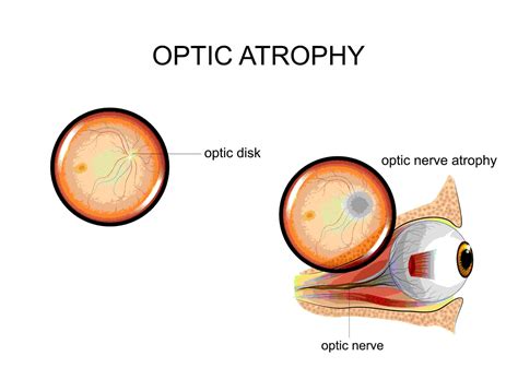 What Are The Signs Of Optic Atrophy And How Do You Reverse It Nvision