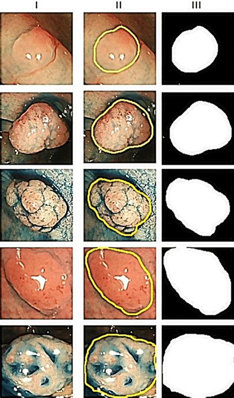 Generation Of Binary Image For Shape Feature Extraction Column I Ii