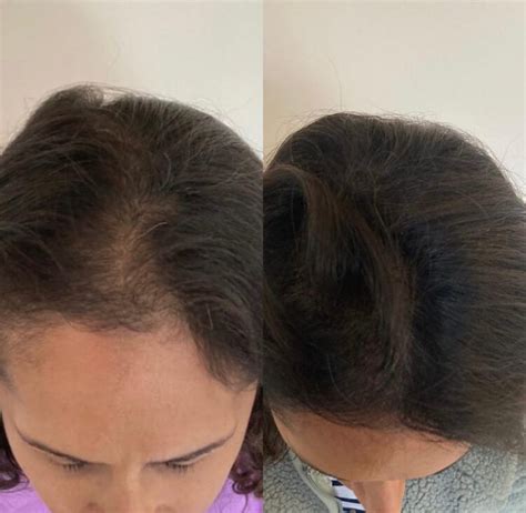 Scalp Micropigmentation Smp For Women Ftg Fusion