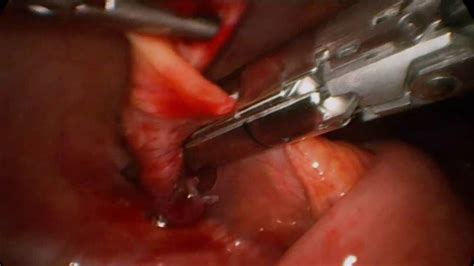 Laparoscopic Appendectomy Using An Endoscopic Stapler International