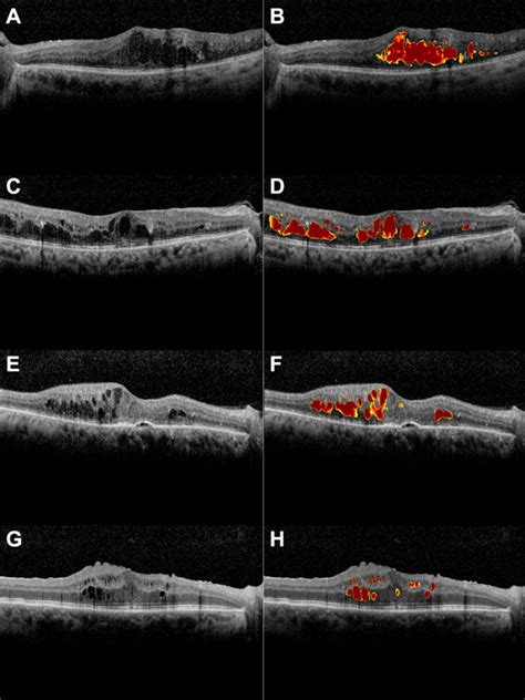 example segmentations of intraretinal fluid from the held out test set