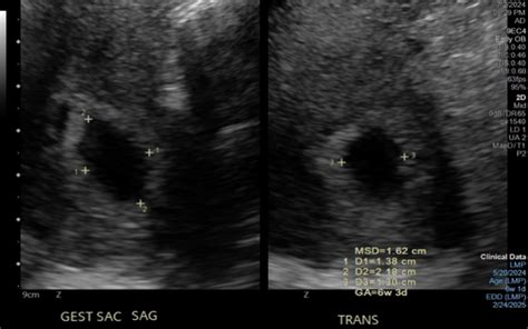 First Trimester Cervical Funneling Rare Case Study