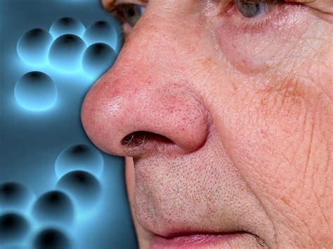 Can You Get Mrsa In Your Nose At Erin Patteson Blog