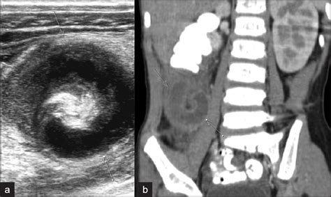 Imaging Acute Appendicitis State Of The Art Journal Of Clinical Imaging Science