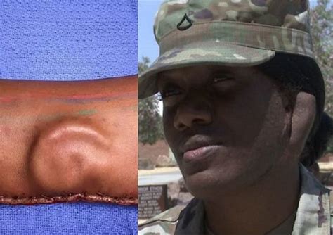21 Year Old Injured Us Soldier Gets New Ear Grown From Her Arm