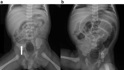 Redundant A Case Of Complicated Dolichocolon In A Neonate Abstract