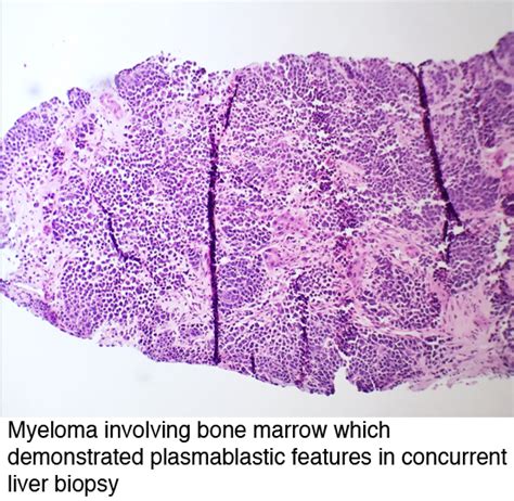 Pathology Outlines Plasma Cell Myeloma Multiple Myeloma