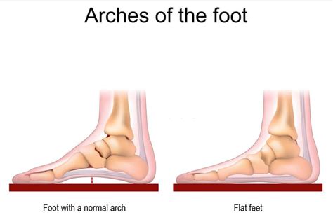 مرکز درمان صافی کف پا در اصفهان پروتزکار