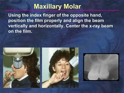 Radio Graphic Techniques Bisecting And Occlusal