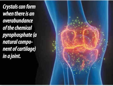 Understanding CPPD Arthritis Advisor