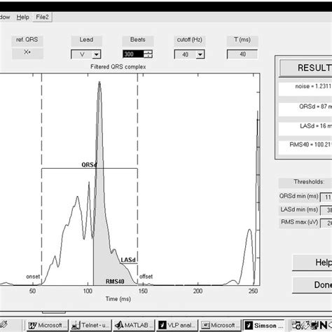 Qrs Detection In Record No 201 Of Mit Bih Arrhythmia Database Download Scientific Diagram