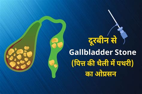 Gallbladder Stone Dr Rajat Kelkar