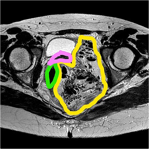 Ischiorectal Abscess Mri