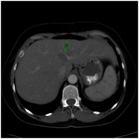The Liver Tumor Segmentation Benchmark Lits Deepai
