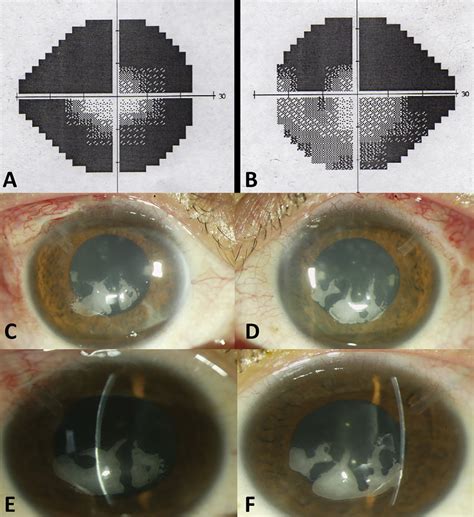 A And B Automated Visual Fields Show Dense Superior And Inferior Download Scientific Diagram