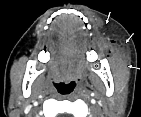 Cellulitis After Third Molar Extraction Axial Contrast Enhanced Ct