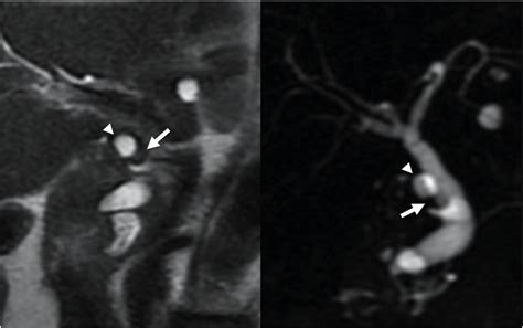 Magnetic Resonance Cholangiopancreatography Findings Magnetic Download Scientific Diagram