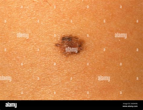 Compound Naevus Close Up Of A Compound Naevus Or Mole On The Skin Of