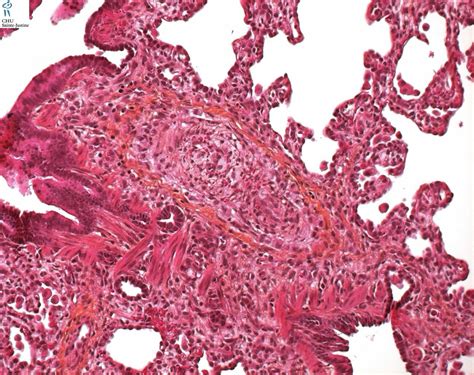 Intimal Fibrosis In Small Pulmonary Arteries Human Pathology