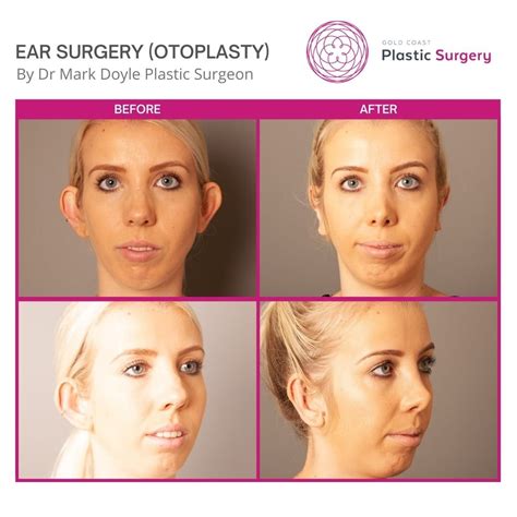 Ear Surgery Otoplasty Gold Coast And Brisbane Plastic Surgeon