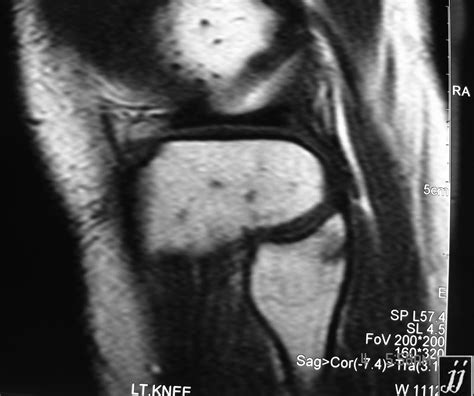 Msk Proximal Tibial Impaction Fracture And Fibular Head Fracture Rare Case 5 Radioogle