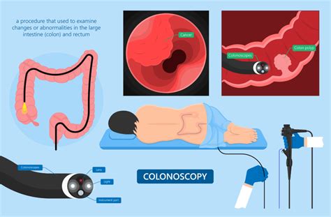 Endoscopy Why You Should Stop Avoiding Scheduling Your Colorectal Colon Cancer Screening