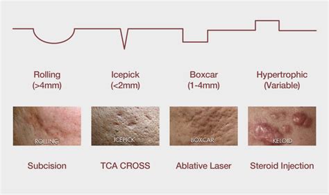 Scar Reconstruction Treating Skin Scars Dr Sin Yong