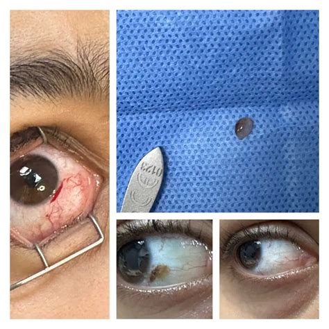 Blue Fin Vision® Conjunctival Naevus Removal In London