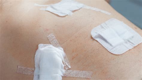Incision Care After Bariatric Surgery Photos Healing And Recovery