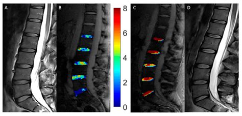 Lumbar Spine Scoliosis Mri