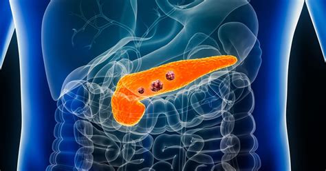 Enzyme Promoting Tumor Growth And Spread In Pancreatic Cancer Identified