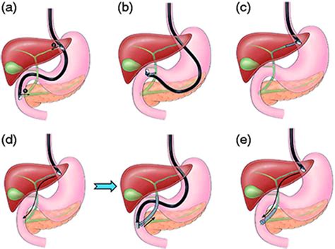 Endoscopic Ultrasound Ercp At Eunice King Blog