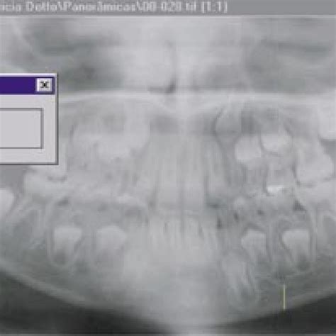 Pdf Evaluation Of The Mental Foramen Position In Pediatric Patients