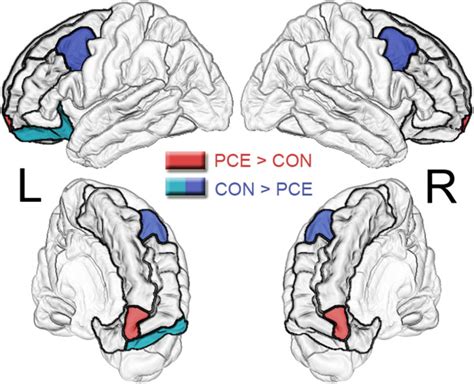Group Differences In Frontal Cortical Brain Volumes Uncorrected Download Scientific Diagram