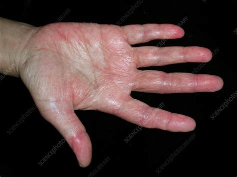 Dermatomyositis Stock Image C056 0910 Science Photo Library