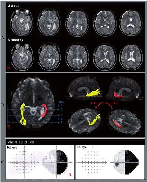 A Brain Mri Showed Contusional Lesions In Left Midbrain Temporal