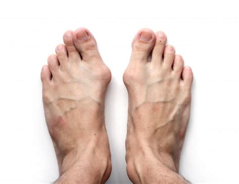 Hallux Valgus Discrimination Classification Dataset By Ewha Womans