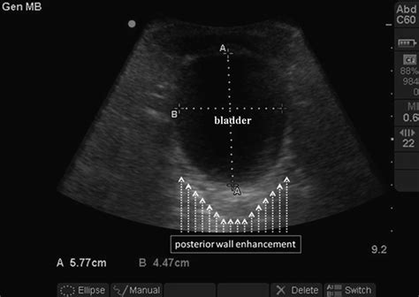 Transverse View Of The Bladder Showing Posterior Enhancement With An