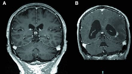Radiation And The Nervous System Practical Neurology
