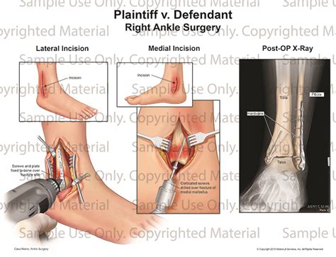 Right Ankle Open Reduction Internal Fixation Motionlit