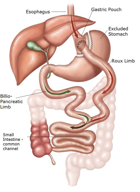 Laparoscopic Roux En Y Gastric Bypass Bmi