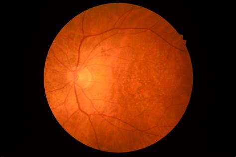 [oct Article] Choroidal Neovascularization With Optovue Solix