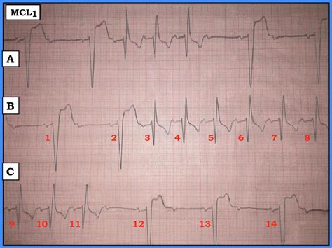 Ecg Interpretation Ecg Blog 130 Av Block Abbb Rbbb Lbbb