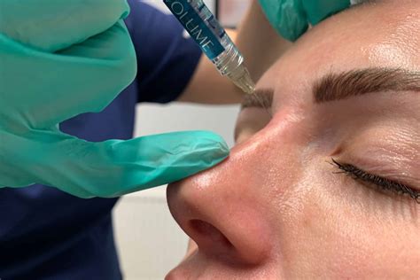 Nose Bump Treatment Freyja Medical