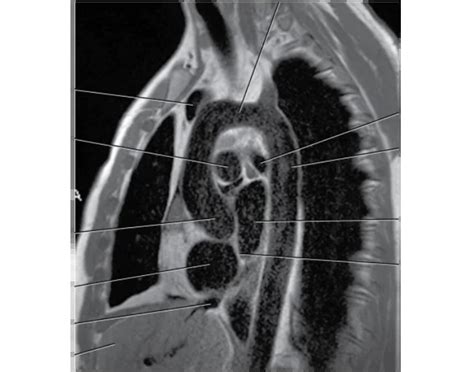 Fig 660 Sagittal T1 Weighted Mri Of Heart With Quiz