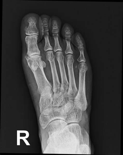 Oblique Fracture Toe