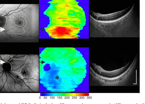 Figure 2 From Choroidal Thickness In Patients With Reticular