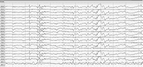 Patient 1 12 Years Old Fragment Of Electroencephalogram Epileptiform