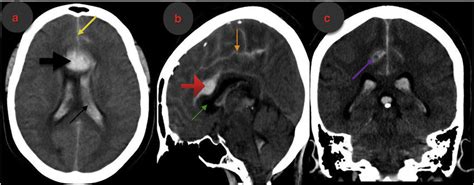 A C Non Contrast Cranial Computerized Tomography Scan 1a Axial Cut